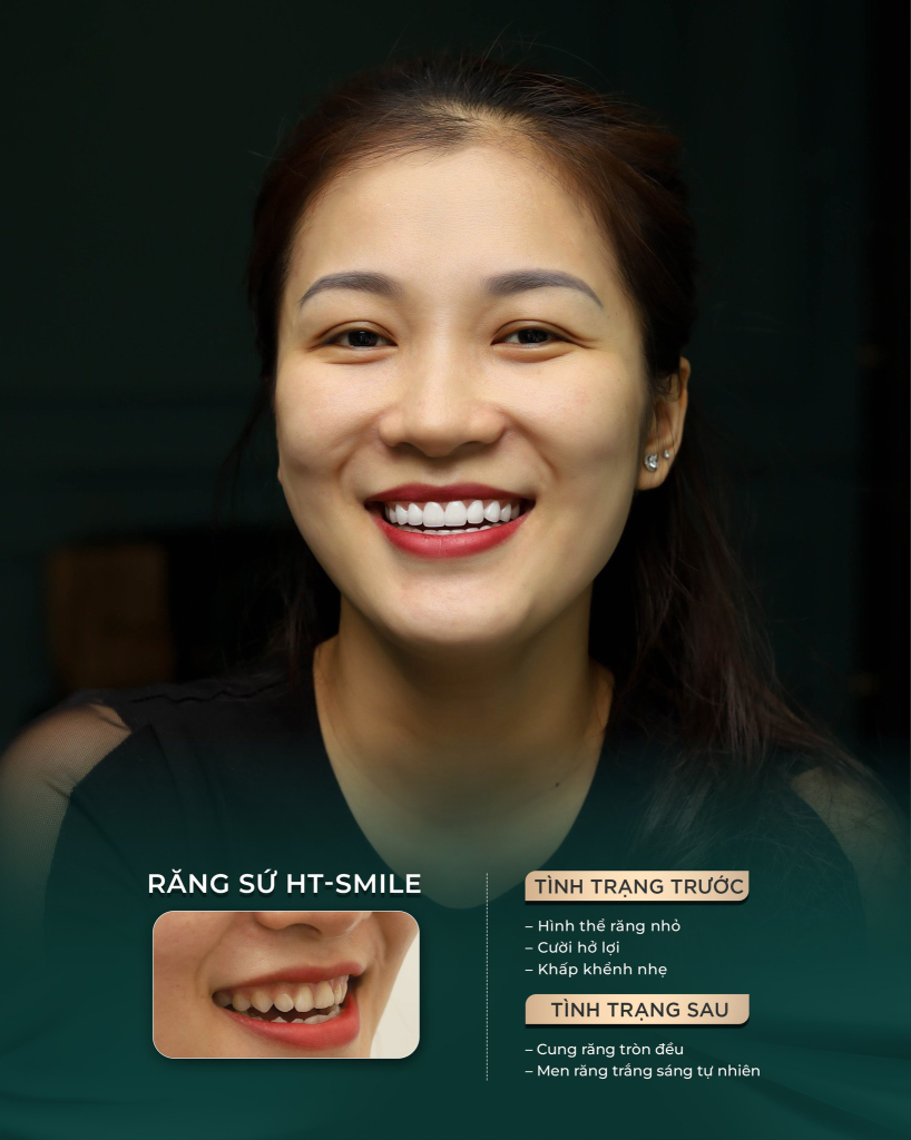 NHỮNG ĐIỀU CẦN BIẾT VỀ RĂNG SỨ CERAMILL VÀ HT SMILE - Review Nha Khoa ...